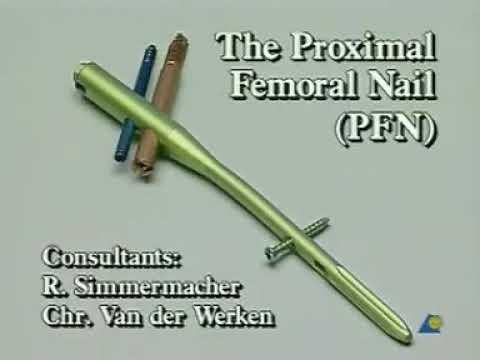 PFN - Proximal Femur Nailing Surgical technique, Tips and Tricks
