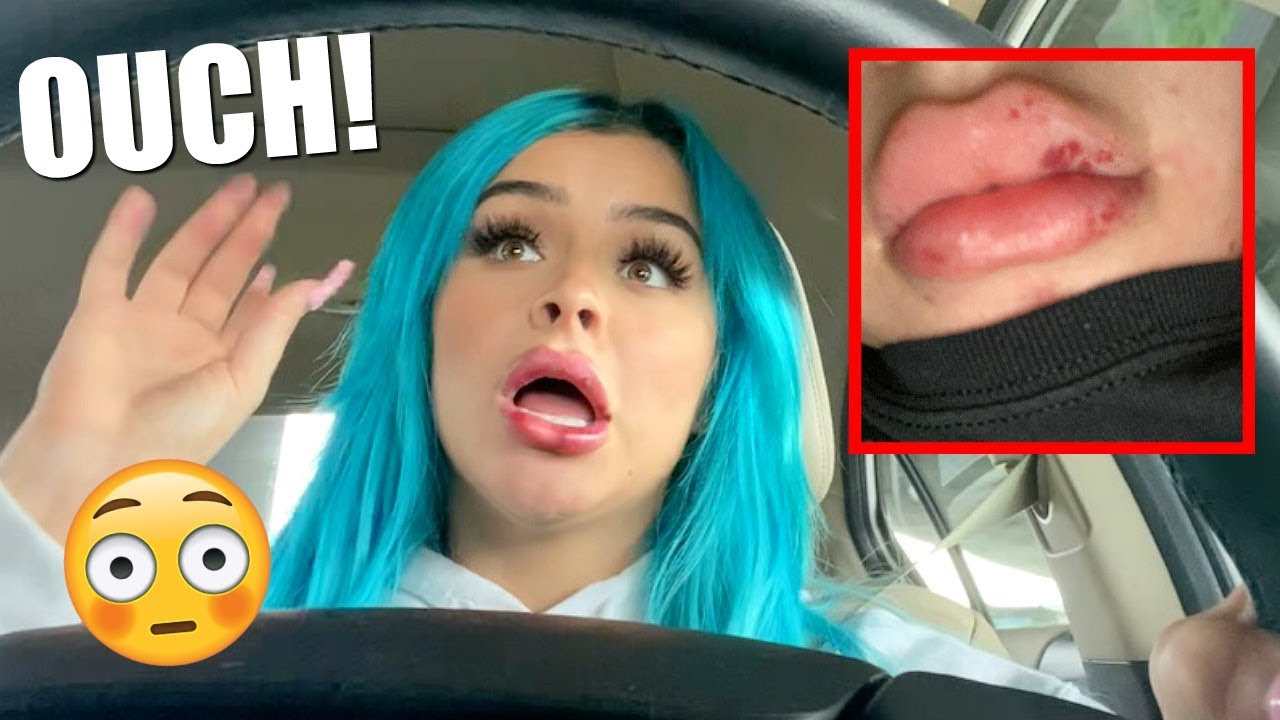my lips are SWOLLEN!! *punched?* - YouTube