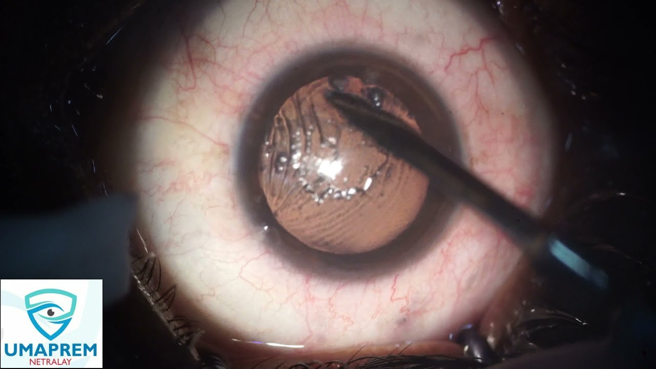 LASIK FLAP DISLOCATION MANAGEMENT...In Umaprem Netralay Varanasi ...