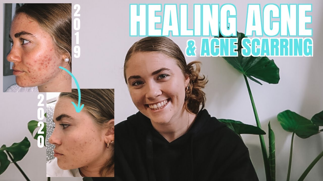 HOW I AM NATURALLY HEALING MY ACNE & ACNE SCARRING [Skin Update] - YouTube