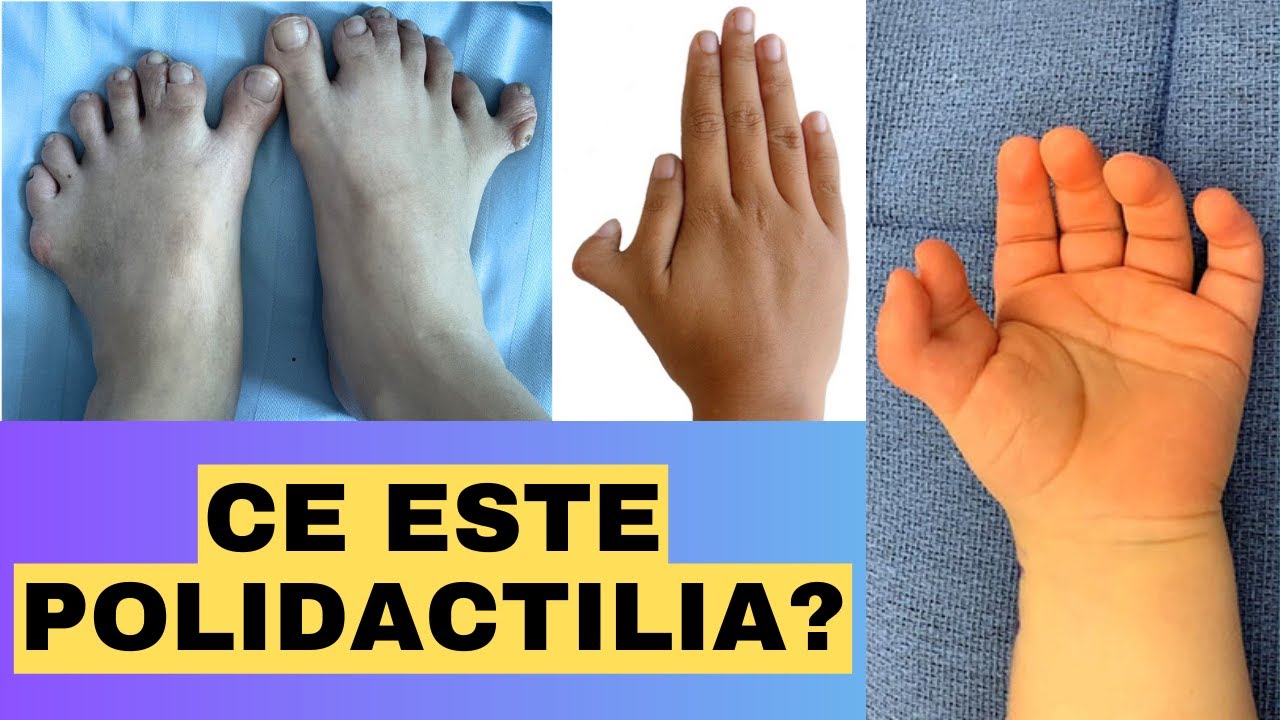 Ce este POLIDACTILIA? - YouTube