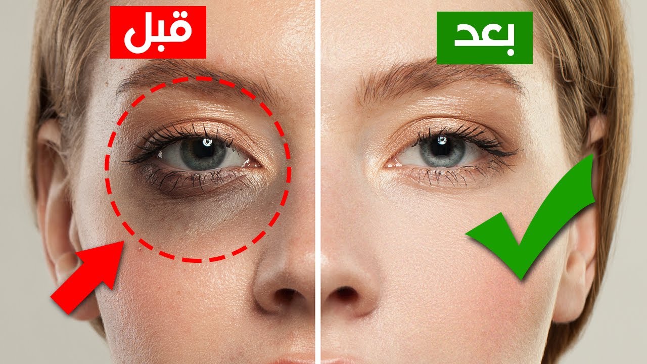 كيفية التخلص من الهالات السوداء تحت العين نهائياً طرق فعالة ومجربة