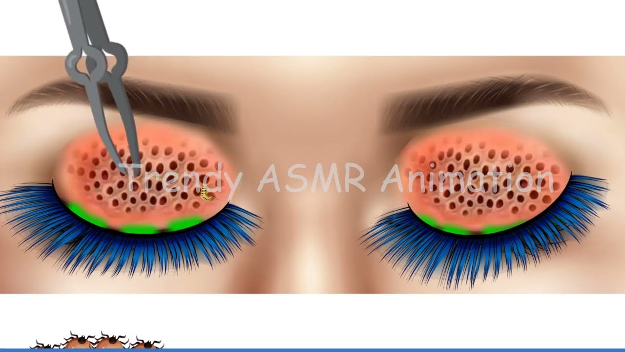ASMR Remove Worm & Deep Cleaning Maggot Infested Eyes- ASMR Removal Dog ...