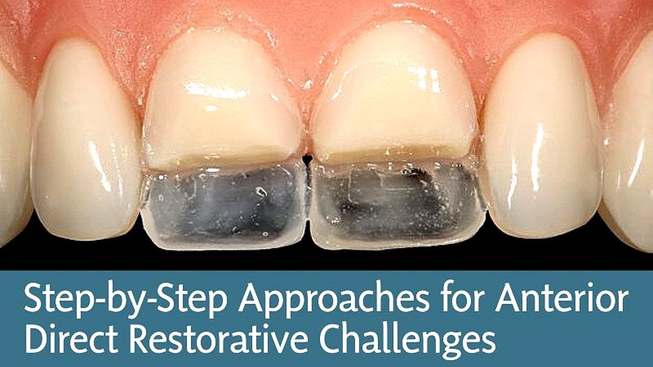 Step by Step Approaches for Anterior Direct Restorative Challenges ...