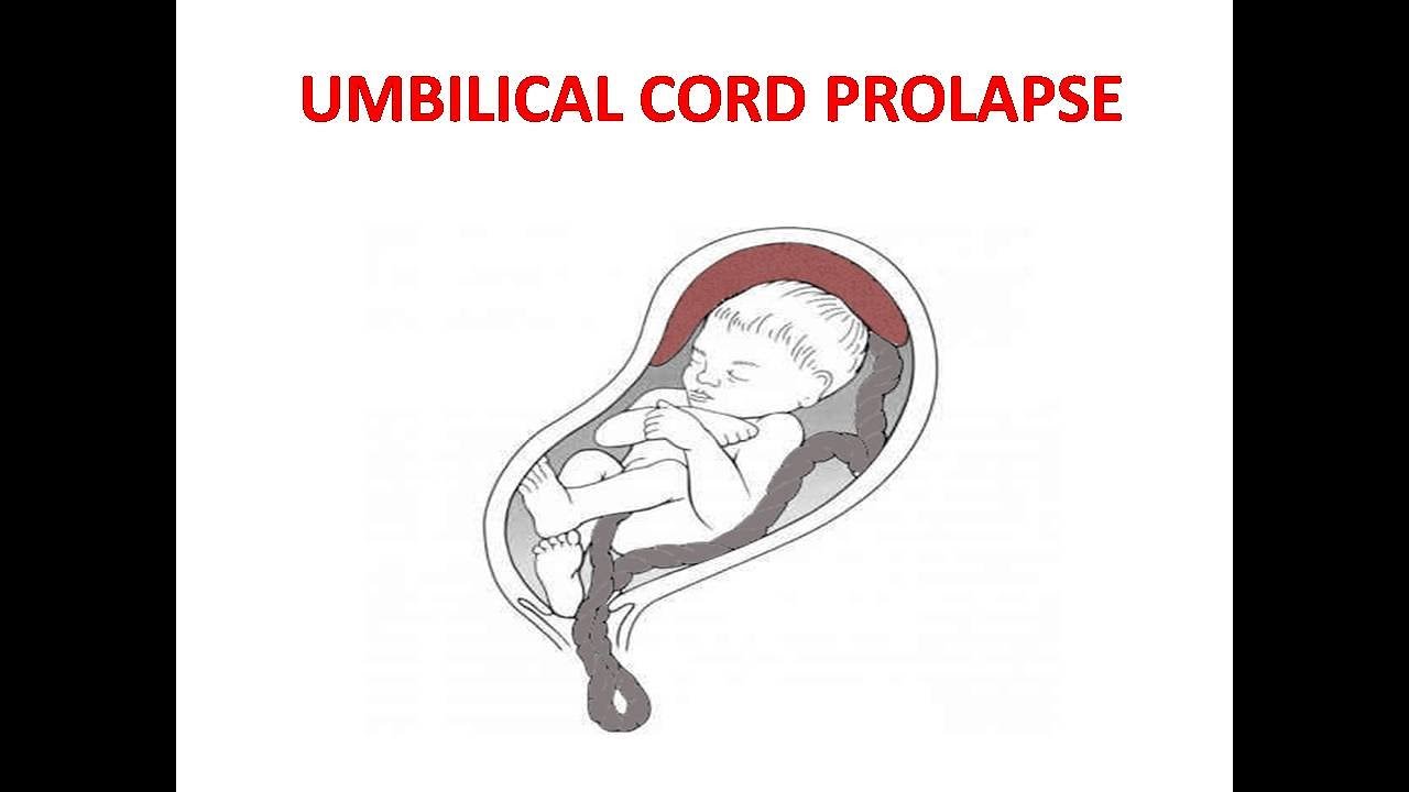UMBILICAL CORD PROLAPSE - YouTube