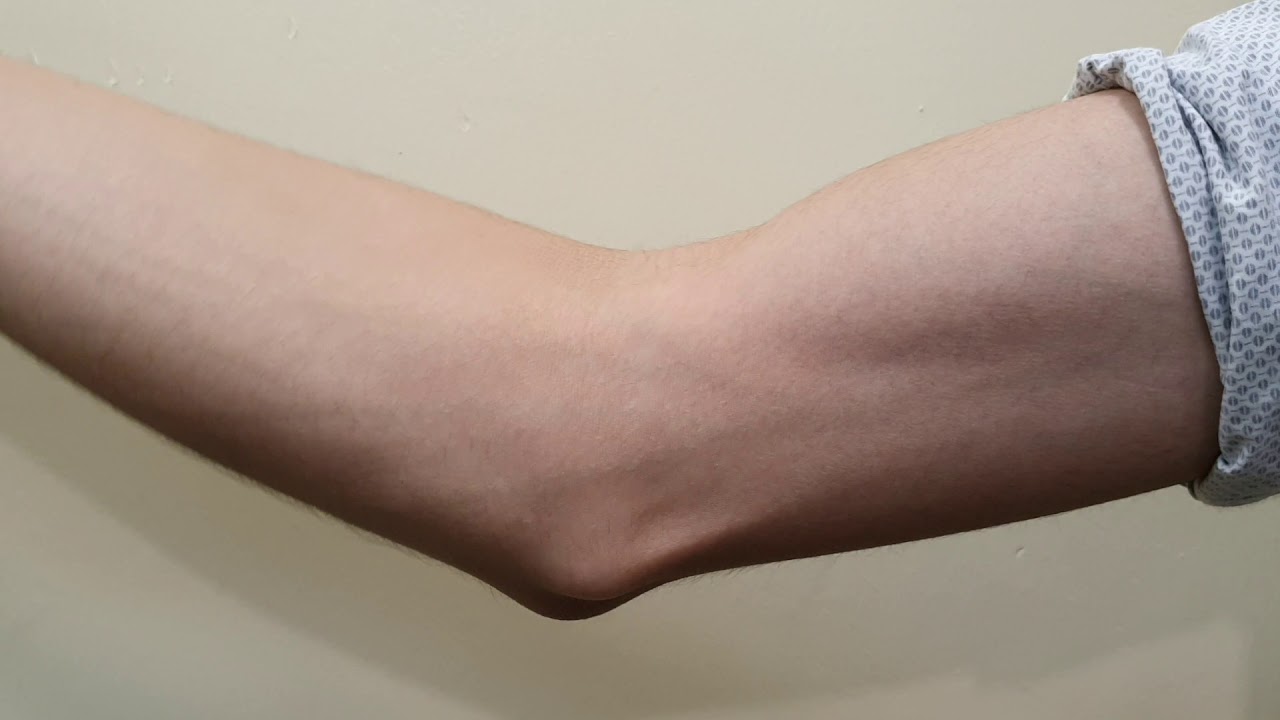 Ulnar Nerve Subluxation - YouTube