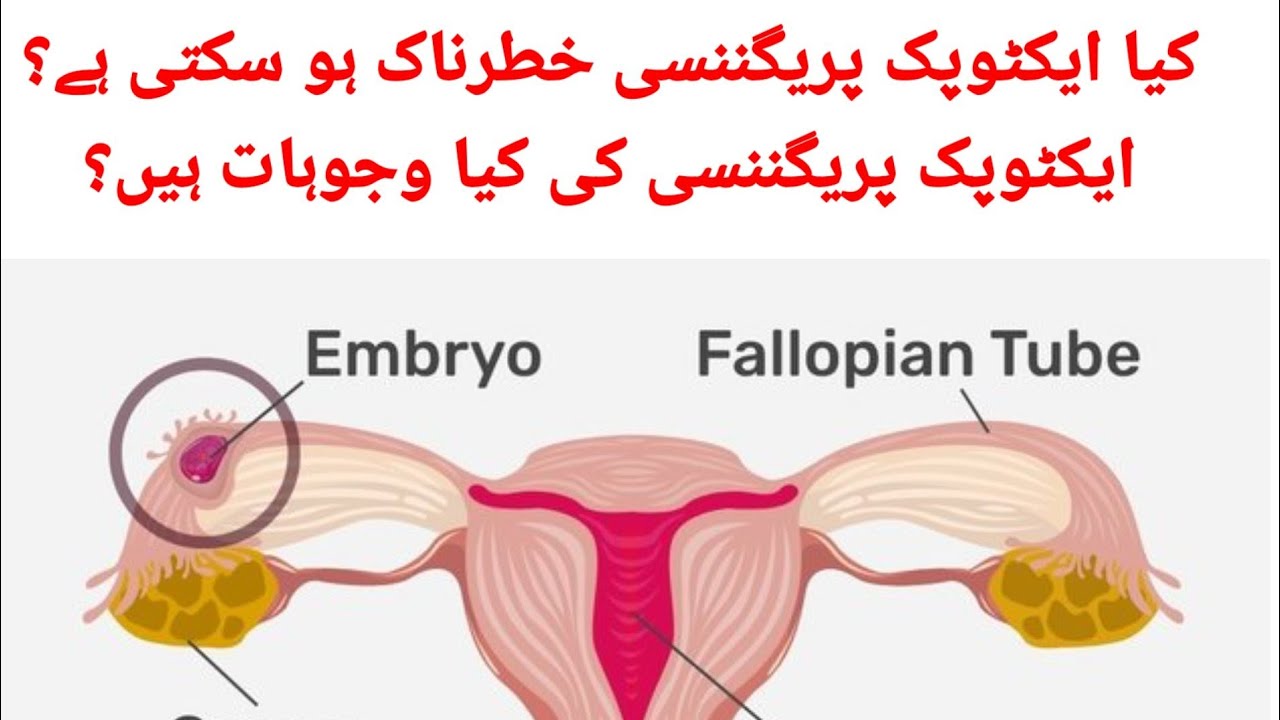 What Causes Ectopic Pregnancy In Urdu L Causes Of Ectopic Pregnancy In What Causes Ectopic Pregnancy In Urdu L Causes Of Ectopic Pregnancy In