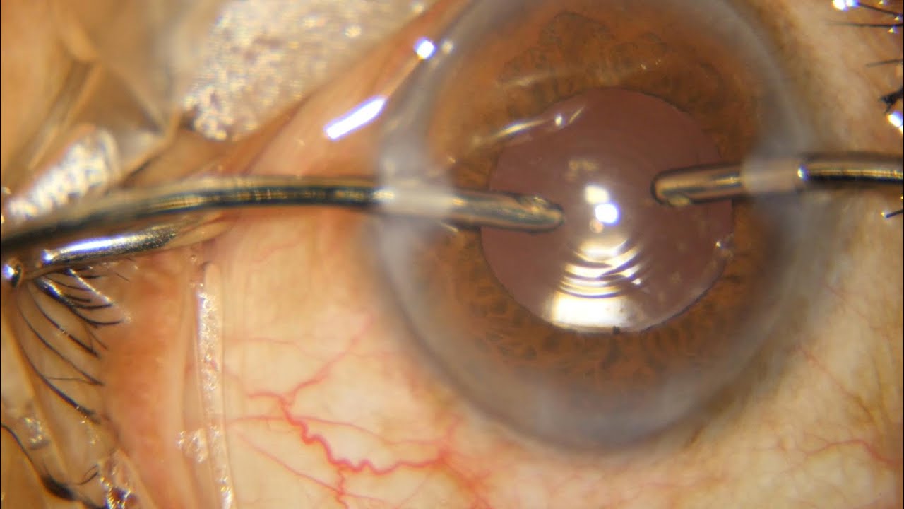 Naturo Panfocal IOL Implantation - YouTube