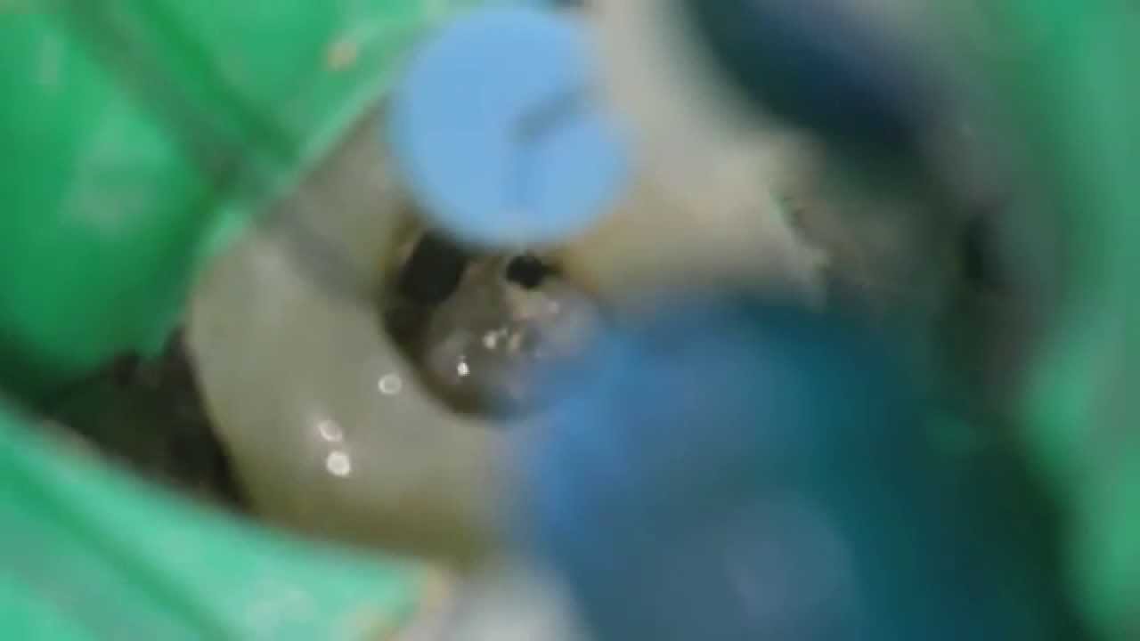 Post induced strip perforation case -Endodontics - YouTube