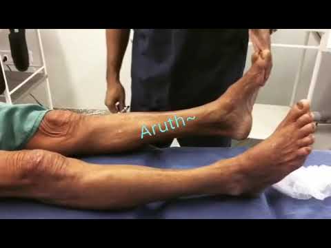 Demonstrando o Sinal de Clônus - Demonstrating the Clonus Sign - YouTube