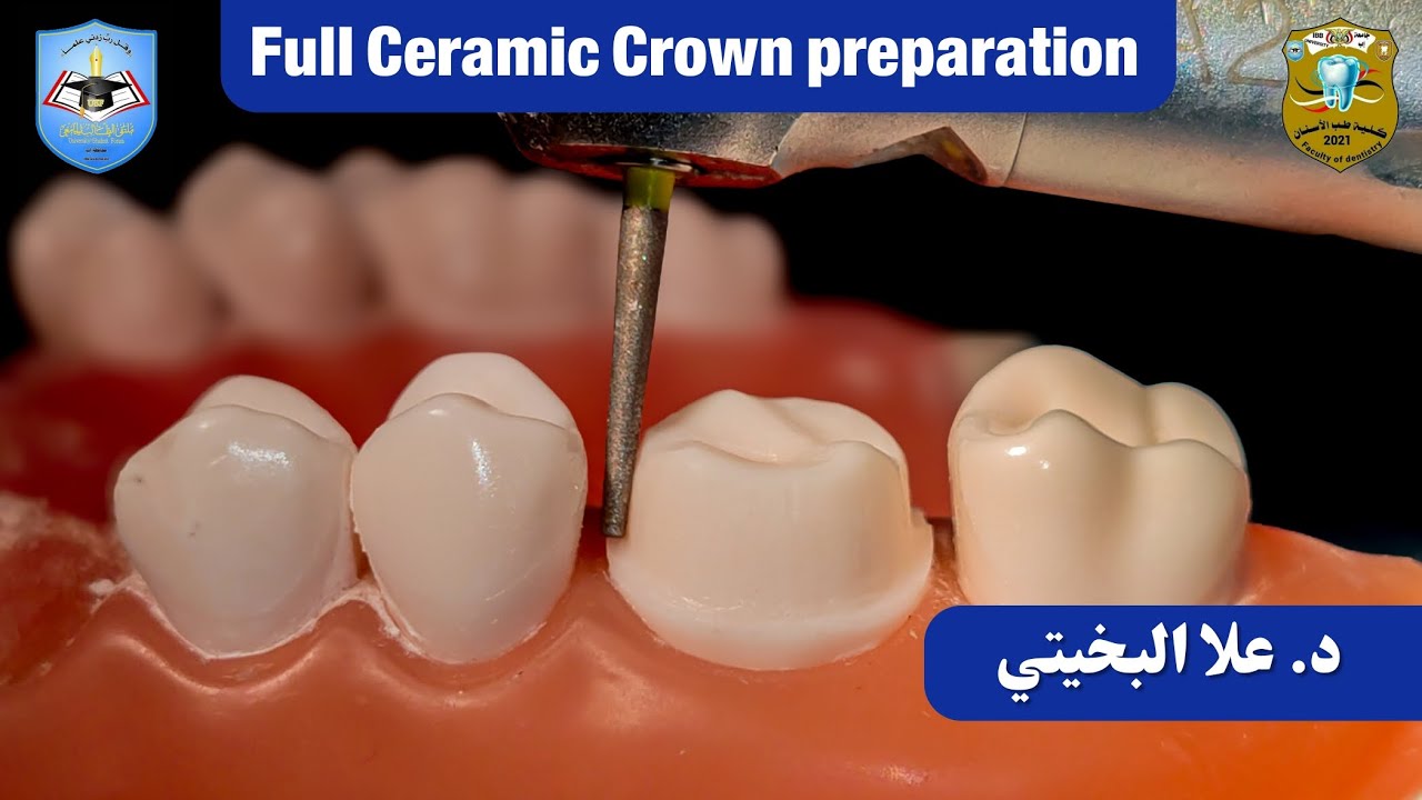 Full Ceramic crown preparation - YouTube