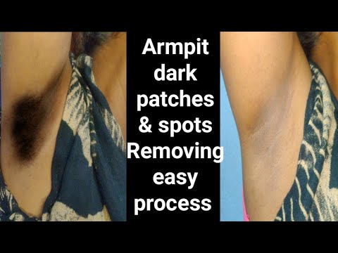 Armpit dark patches & spots Removing easy process - YouTube
