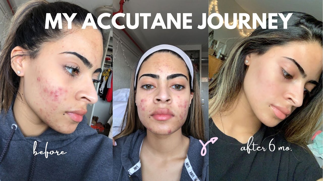 Accutane Before And After Bacne