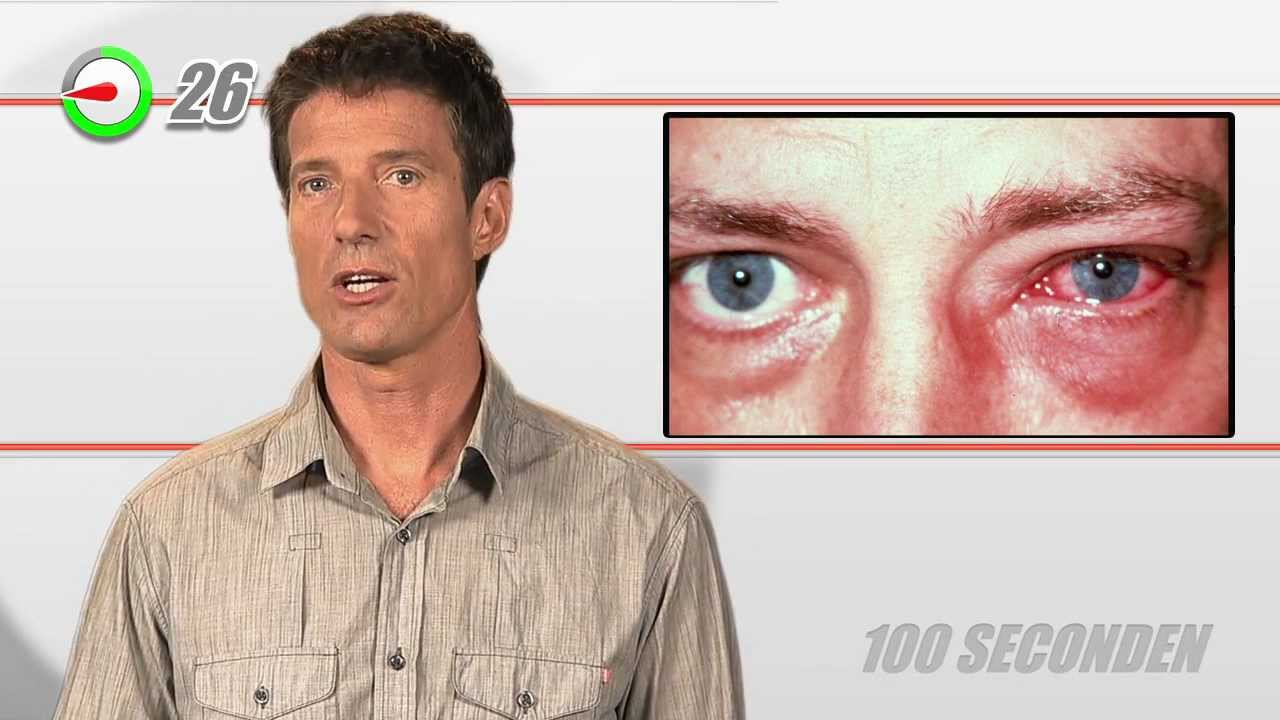 Oogontsteking | 100 Seconden Dokter - YouTube
