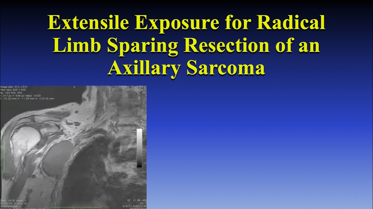 Extensile Exposure for a Radical Limb Sparing Resection of an Axillary ...