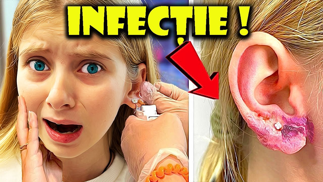 🚑 INFECȚIE purulentă la URECHE 👂 din cauza CERCEILOR 🙏 Ajutați-ne cu ...