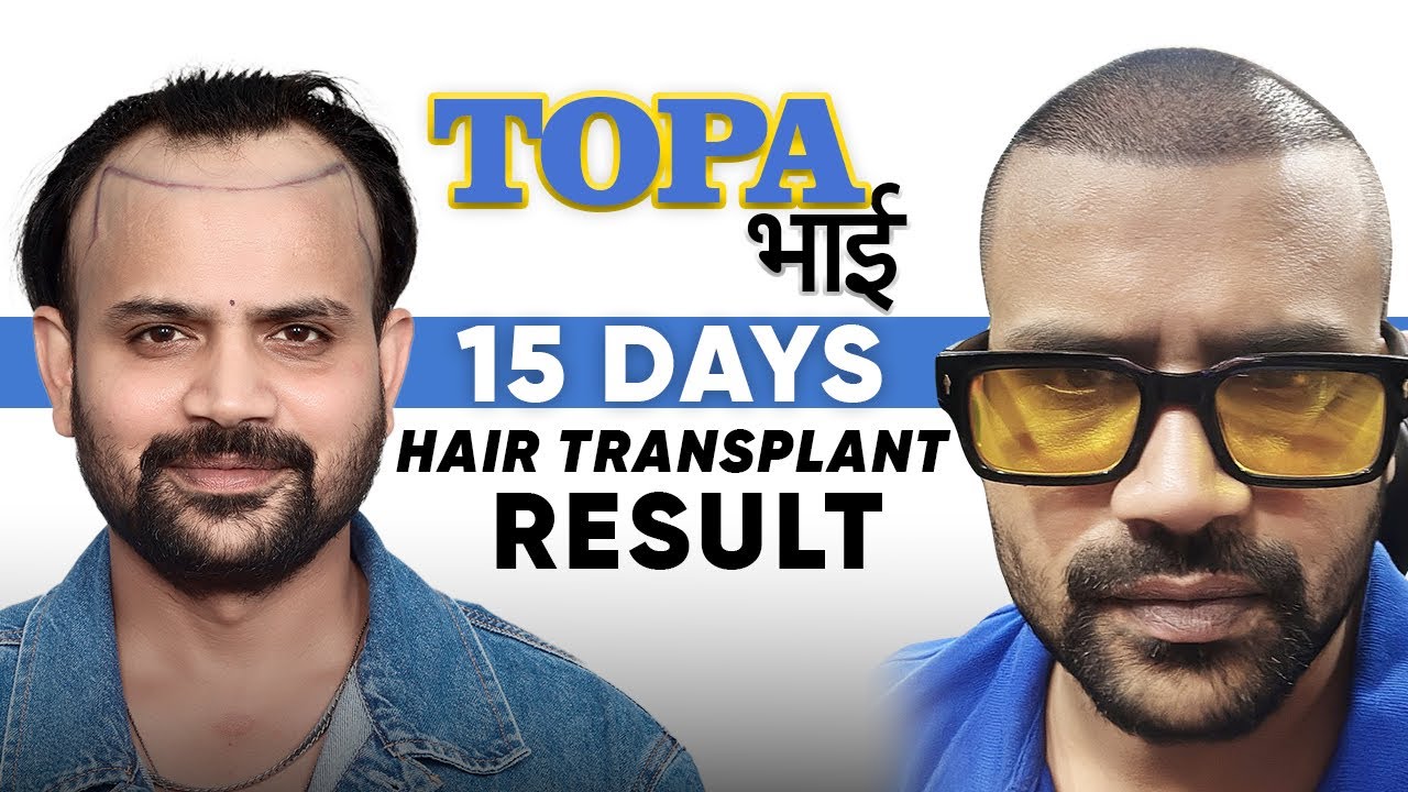 Sevengers fame Topa Bhai 15 Days Hair Transplant Result | Best Hair ...