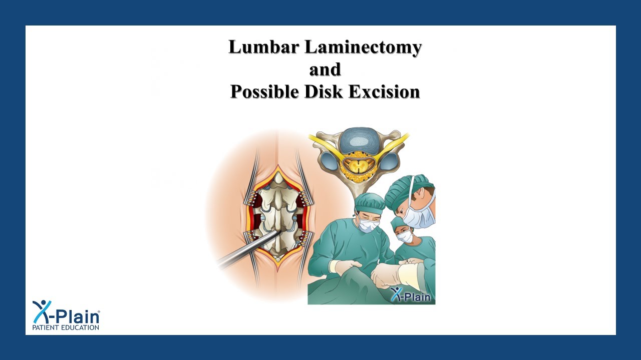 Lumbar Laminectomy and Possible Disk Excision - YouTube