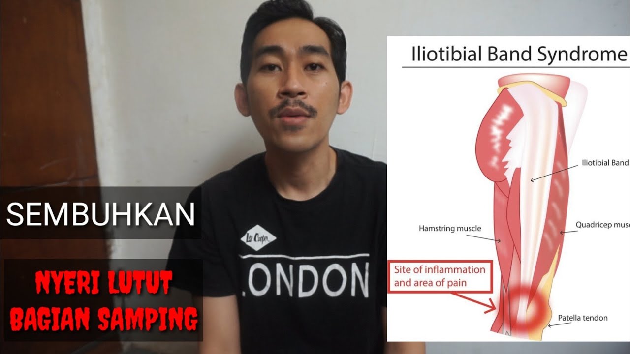 CARA CEPAT MENYEMBUHKAN NYERI LUTUT BAGIAN SAMPING (ITBS) - YouTube