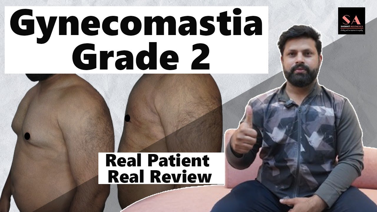 Gynecomastia Grade 2 Real Patient Real Review - YouTube