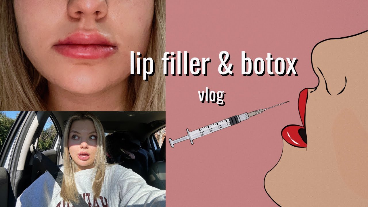 I GOT LIP FILLER & BOTOX; my lip filler and botox experience , before ...