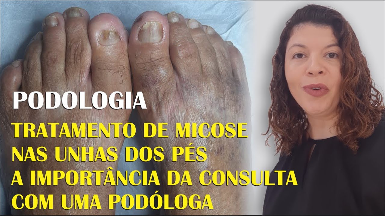 Como Tratar A Micose Dos Pés? : Micose nos pés: entenda o que é e como ...