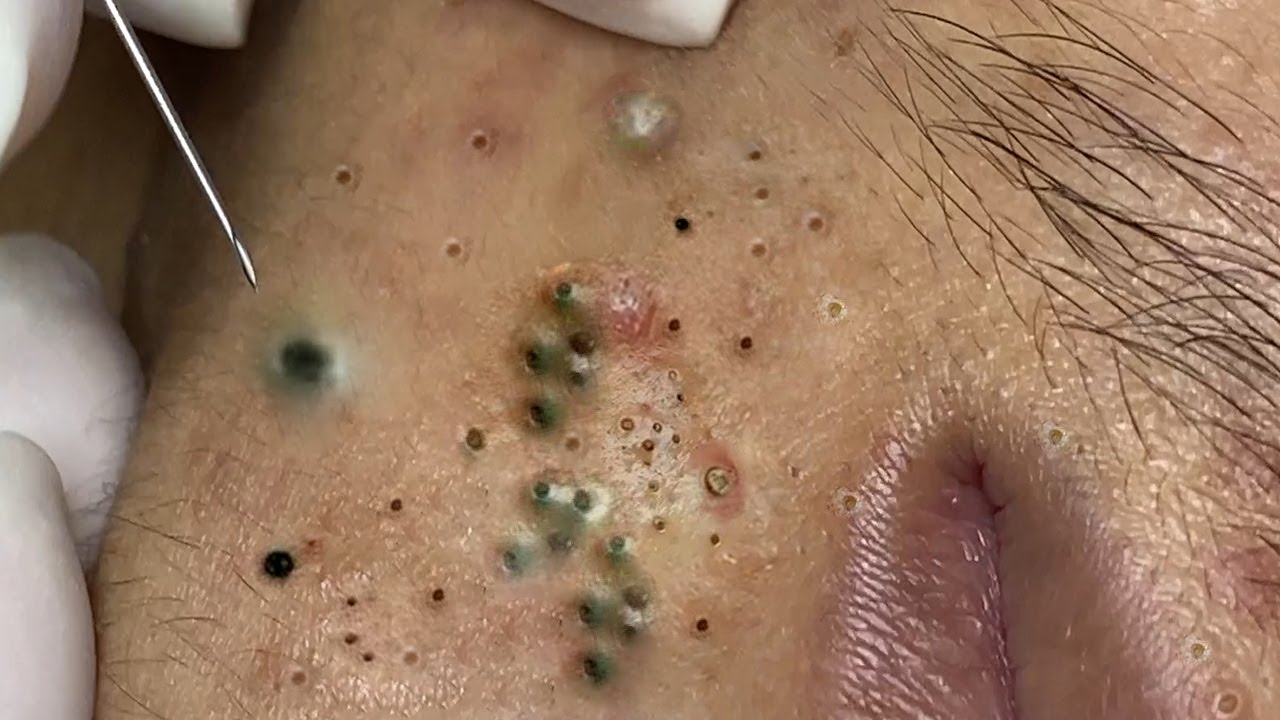 Big Cystic Acne Blackheads Extraction Blackheads & Milia, Whiteheads ...