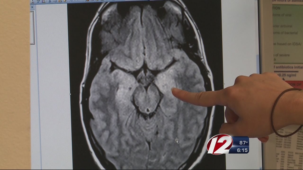 Severe Triple E Treatment - YouTube