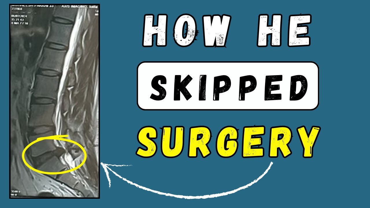 Lumbar Disc Extrusion recovered and skipped surgery - YouTube