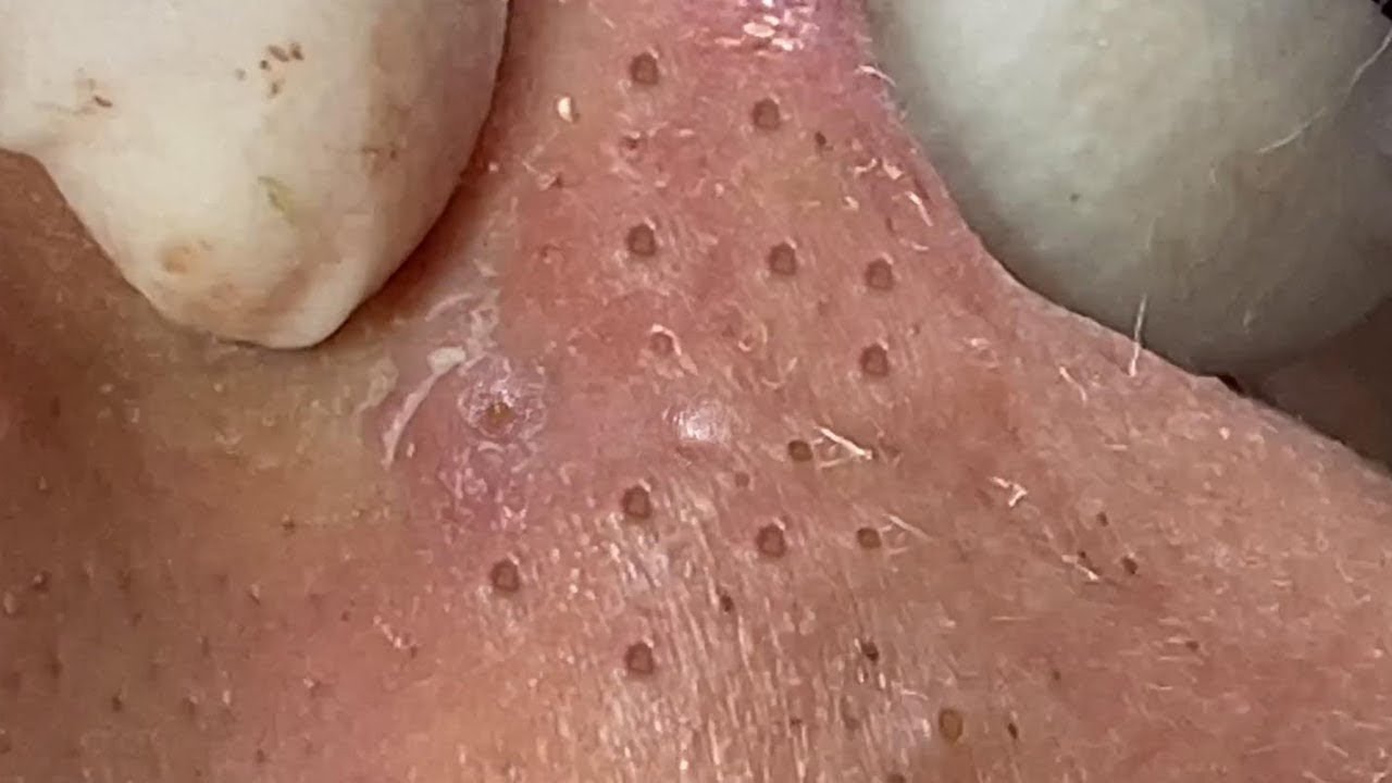 Big Cystic Acne Blackheads Extraction Blackheads & Milia, Whiteheads ...