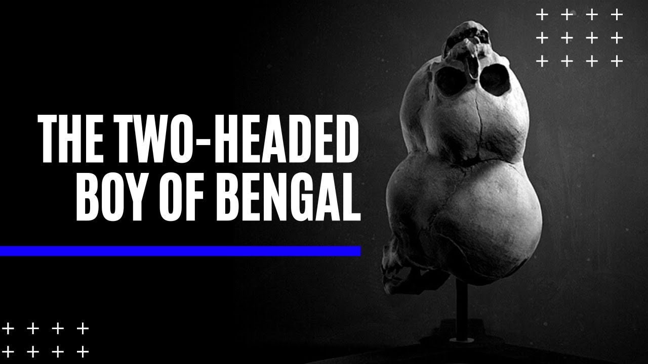 The tragedy of " Two-Headed Boy of Bengal" - YouTube