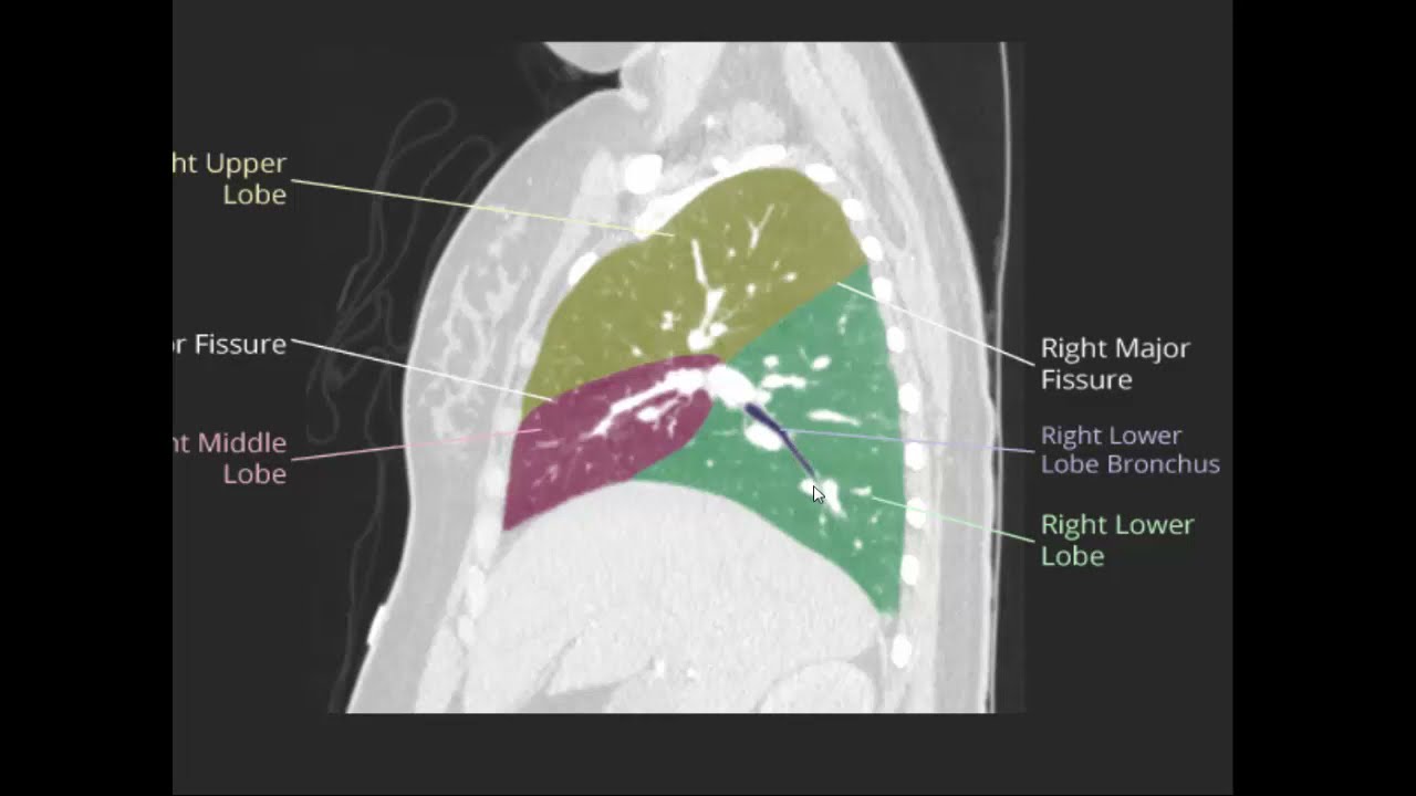 HRCT chest sagittal with voice - YouTube
