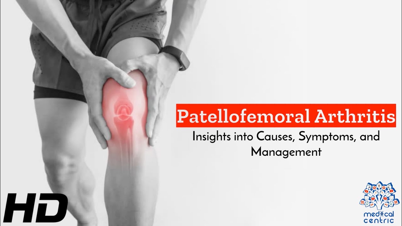 Patellofemoral Arthritis: Navigating the Challenges - YouTube