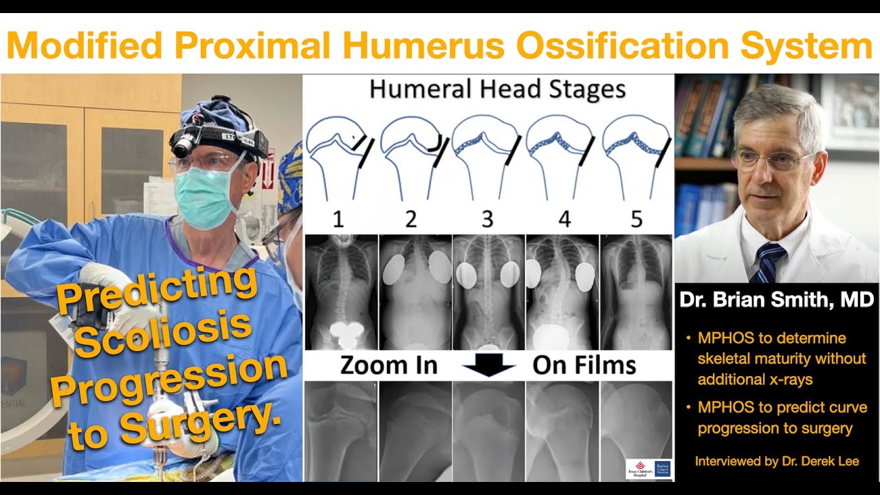 Dr. Brian Smith, MD: Modified Proximal Humerus Ossification System for Skeletal Maturity ...