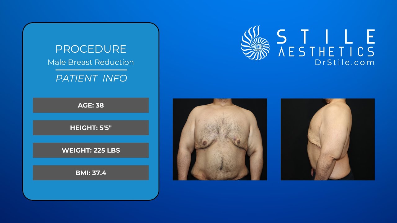 Live Male Mastopexy August 9th, 2024 - YouTube