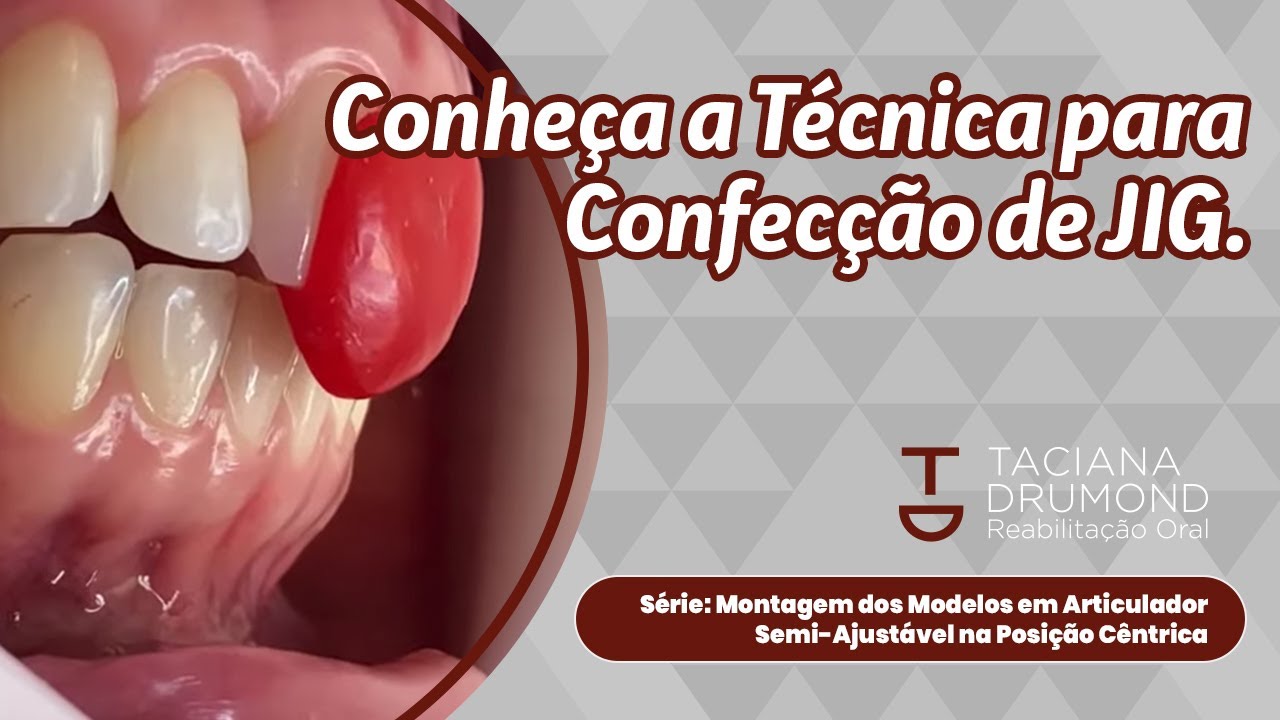 Técnica para Confecção do Jig para Obtenção da Relação Cêntrica com ...