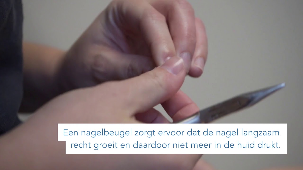 BEHANDELMOGELIJKHEID INGEGROEIDE NAGEL - Dit kan een oplossing zijn ...