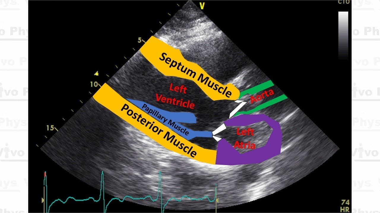 Hypertrophic Cardiomyopathy Parasternal Long Axis Echocardiogram View ...
