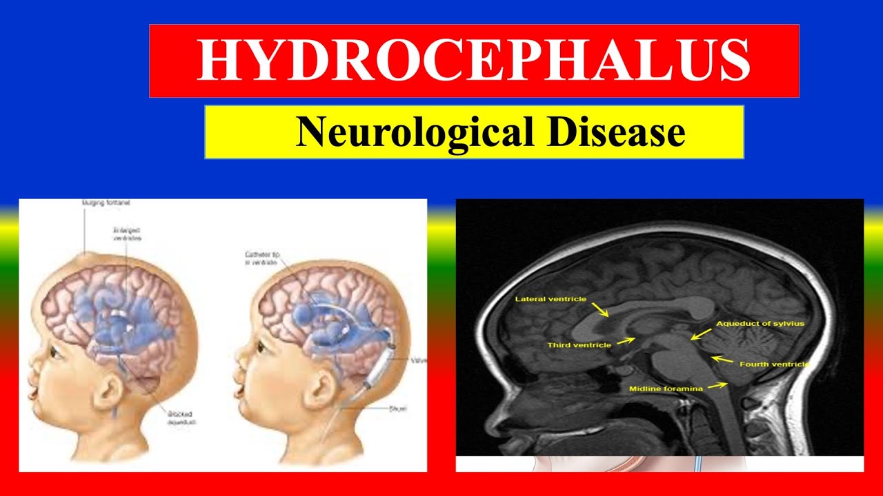 HYDROCEPHALUS - Explained | Definition, types , cusses ,risk , symptoms ...