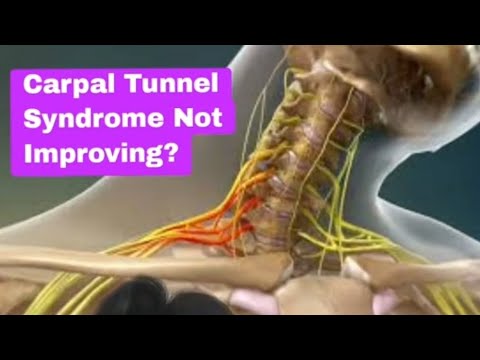 Tingling, numbness, or grip weakness in your hands? Dropping things ...