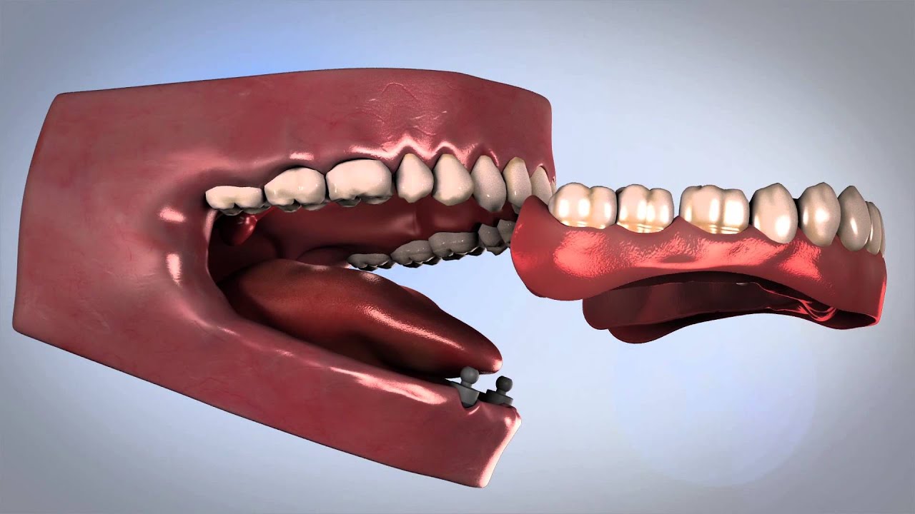 Polish: Cortex Dental Implants - A Friendly Movie for the Patient - YouTube