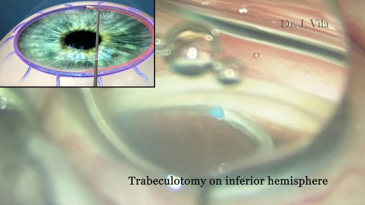 OMNI Glaucoma Surgery - YouTube