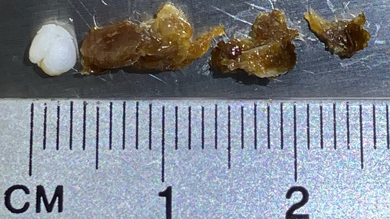 50 - Polystyrene Ball Lodged in 3 Year Old’s Ear Removed using WAXscope ...