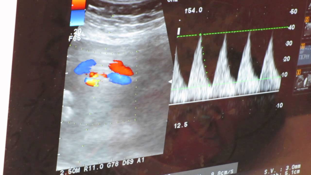 My Ultrasound of Zailey Anne - YouTube