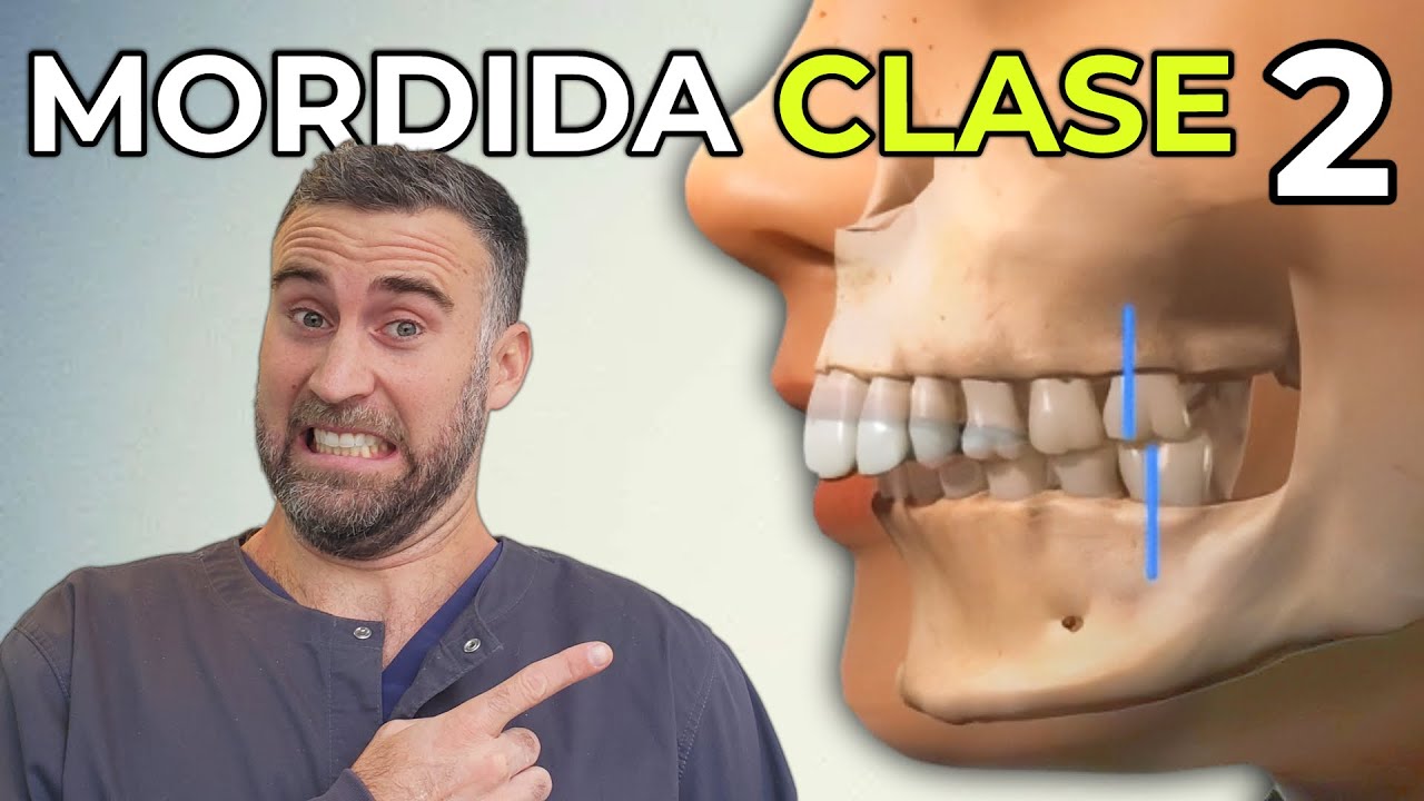 MORDIDA CLASE 2 maloclusión 🚦 TRATAMIENTO de la MANDÍBULA PEQUEÑA ...