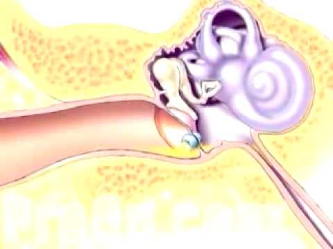 PreOp® Patient Education Myringotomy Insertion of Tube 3 - YouTube