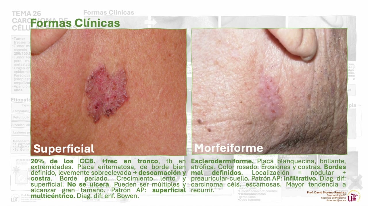 Carcinoma Basocelular Infiltrativo Manejo Quirúrgico Conservador Del