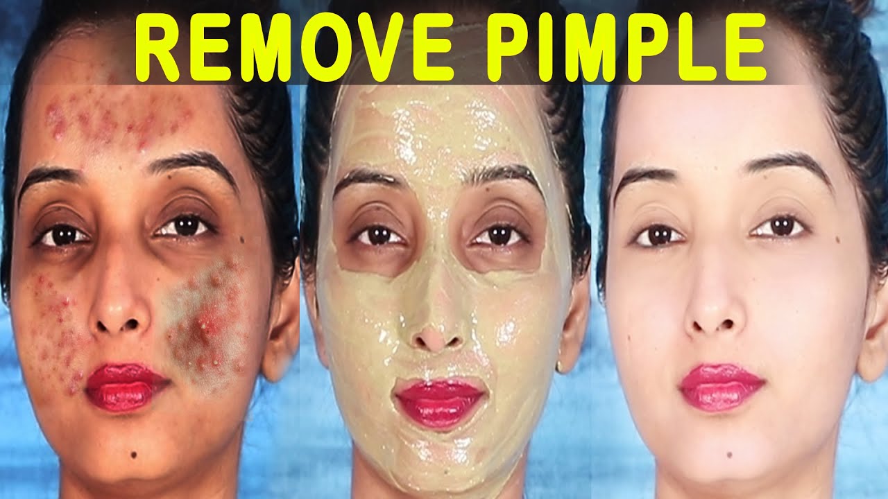 कील – मुहांसे (Pimples,Acne) हटाने के जबरदस्त उपाय | Remove Pimple Acne ...