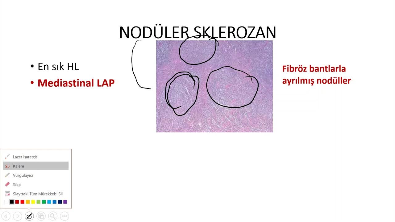 Hodgkin Lenfoma - YouTube