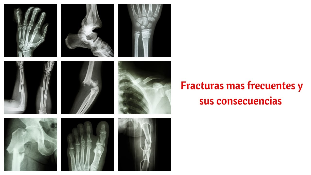 Fracturas mas frecuentes y sus consecuencias (2da parte) - YouTube